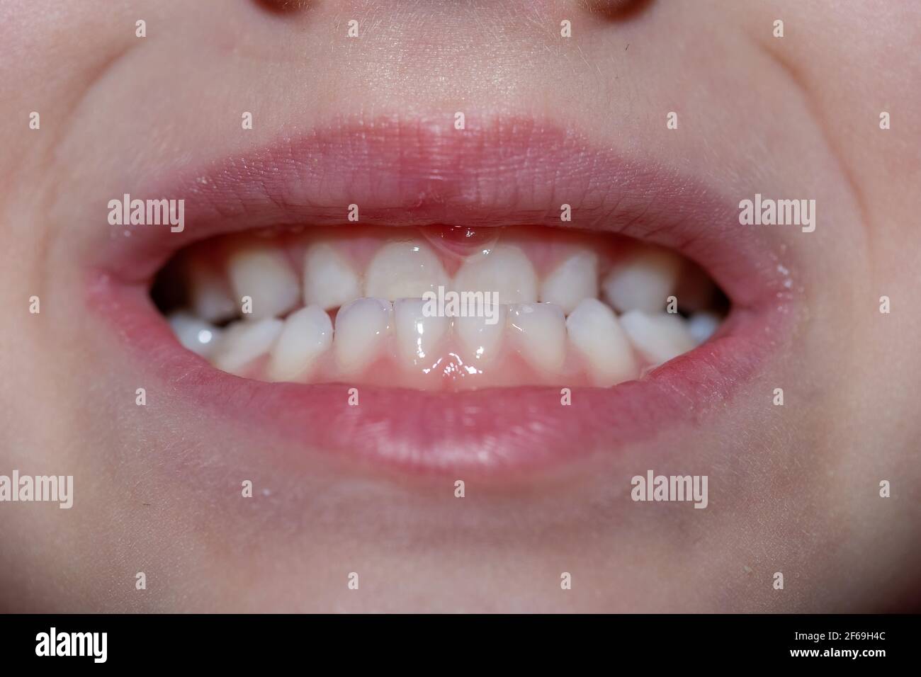 Malocclusion of a child, close-up on the front teeth of a child Stock ...