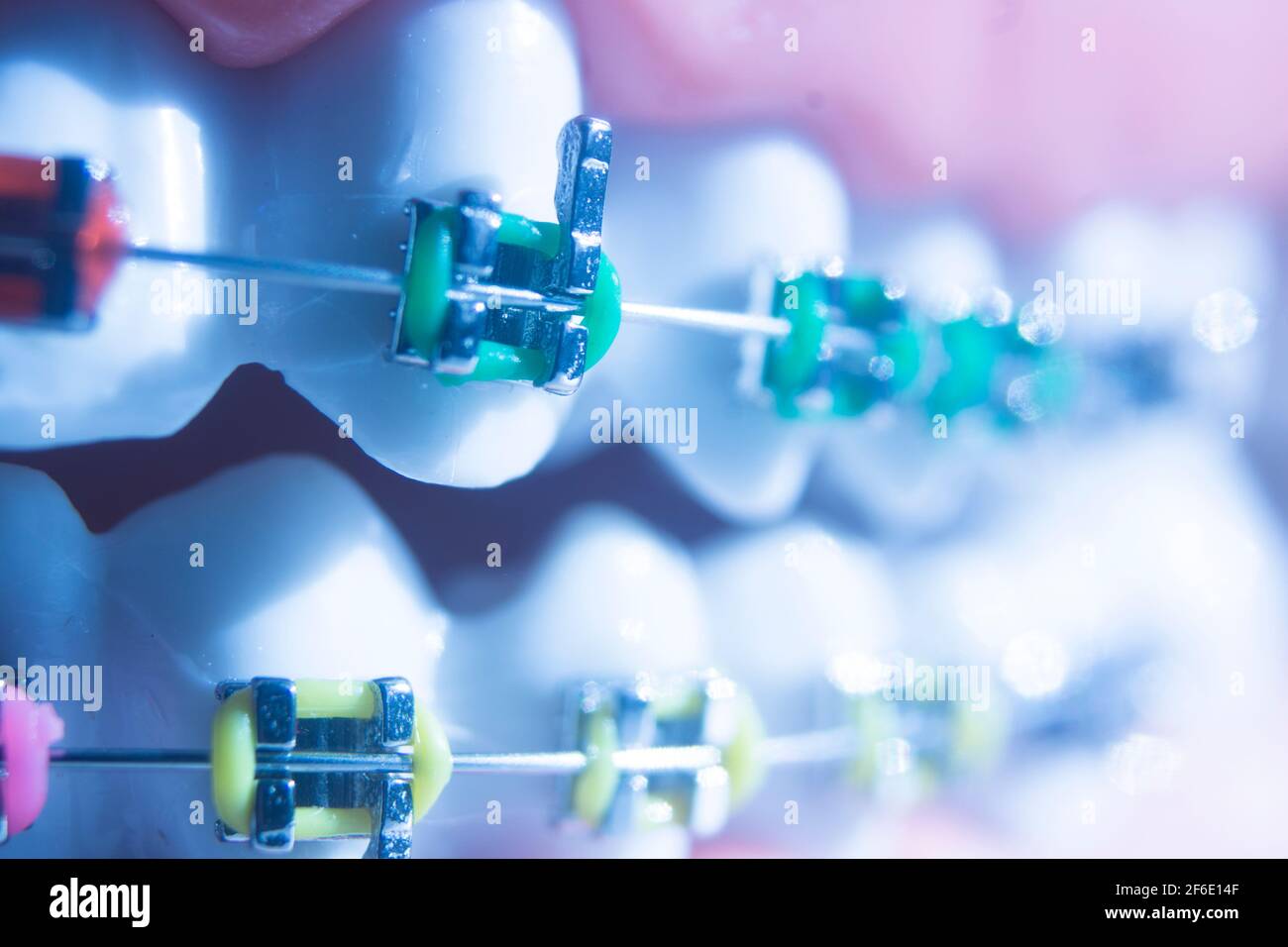 Modern metal brackets aligner straighterners used to correct alignment ...