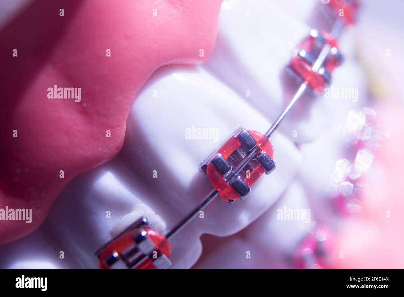 Modern metal brackets aligner straighterners used to correct alignment ...