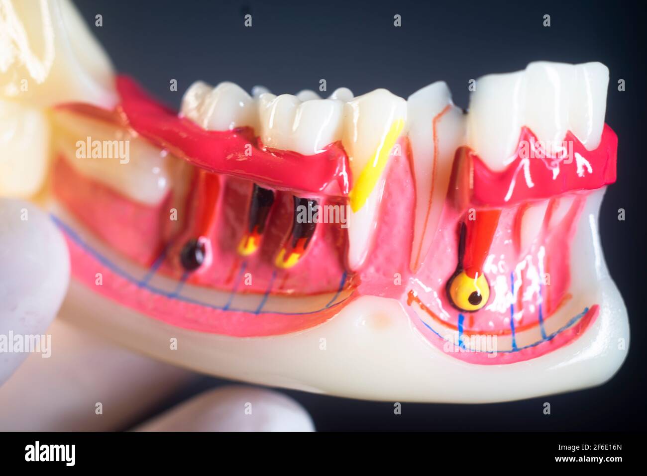 Tooth decay dentists dental model of teeth, gums and root canal Stock ...