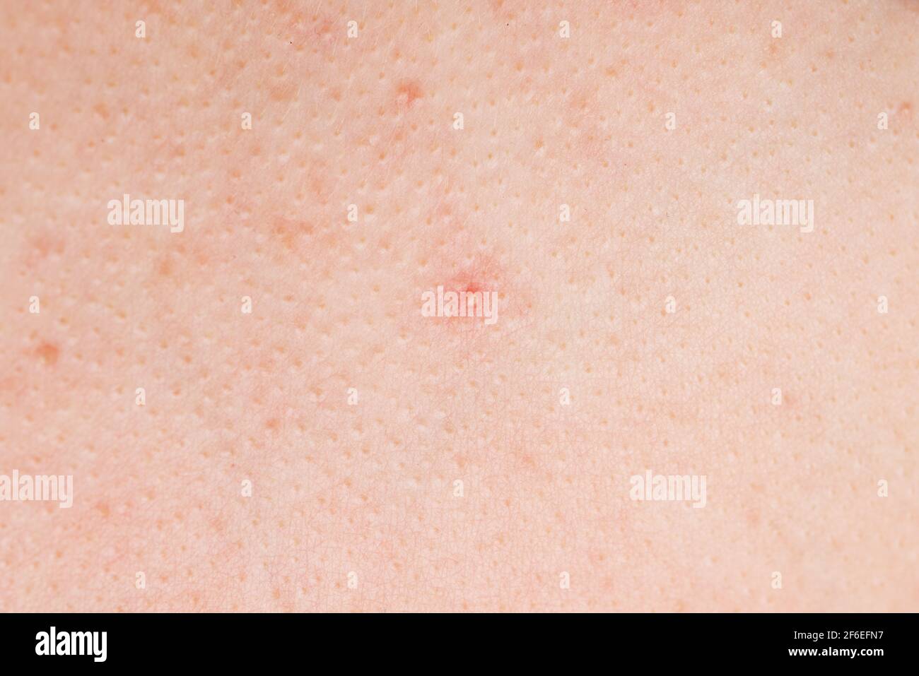 Puberty pustule hi-res stock photography and images - Alamy