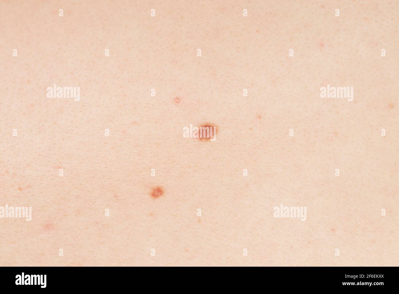 Skin mole hi-res stock photography and images - Alamy