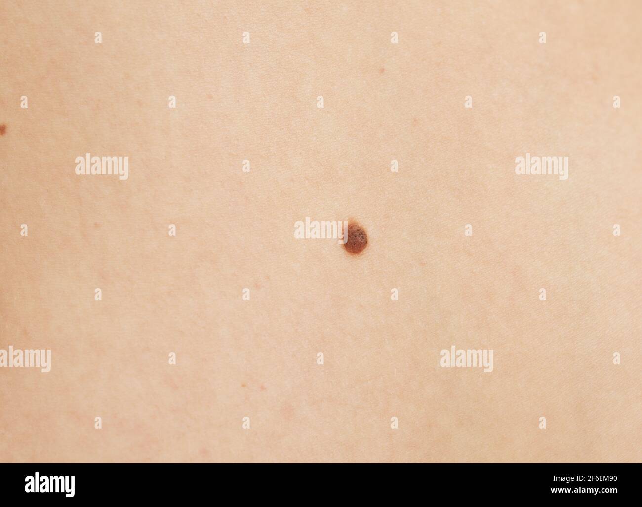 Skin mole hi-res stock photography and images - Alamy