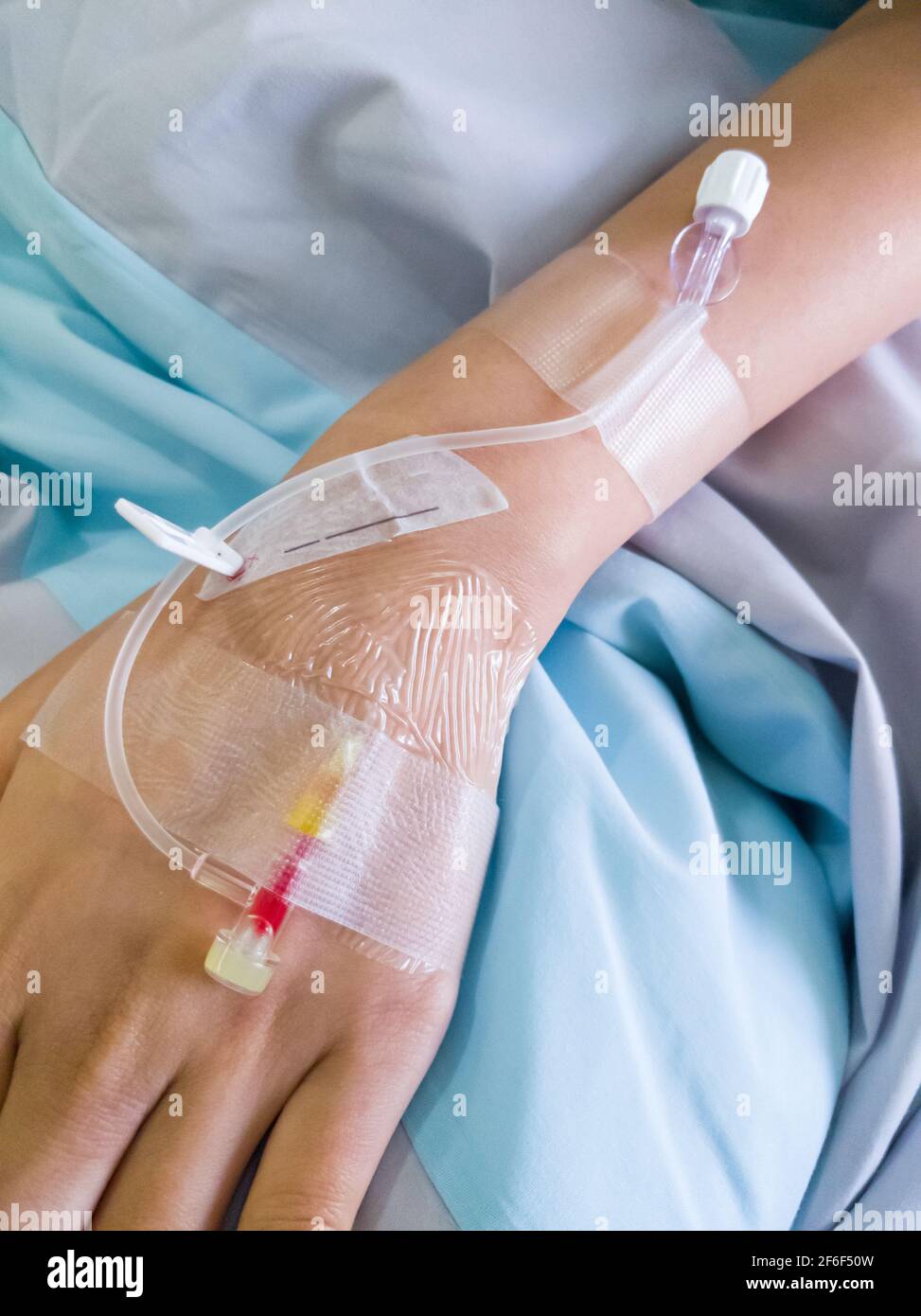 The piercing needle for giving saline solution to patients on the back ...