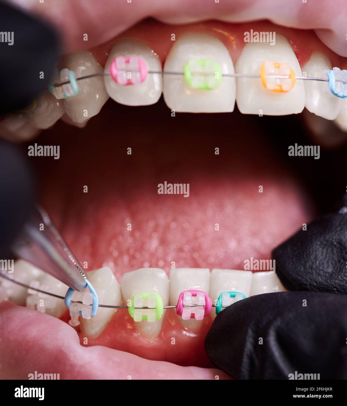 Placing braces hi-res stock photography and images - Alamy