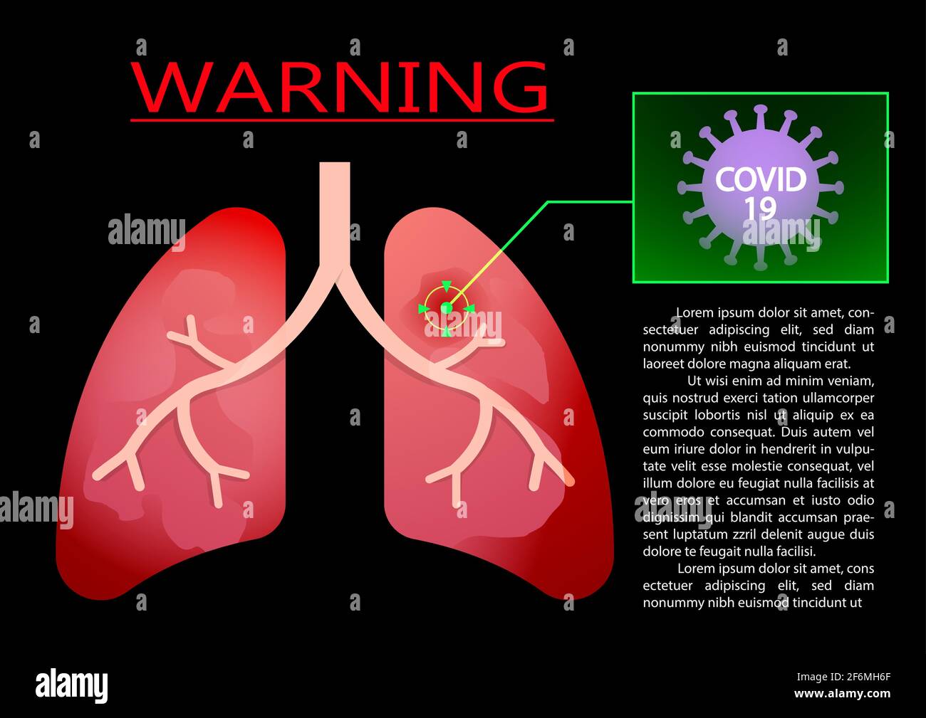 Illness pneumonia Stock Vector Images - Alamy