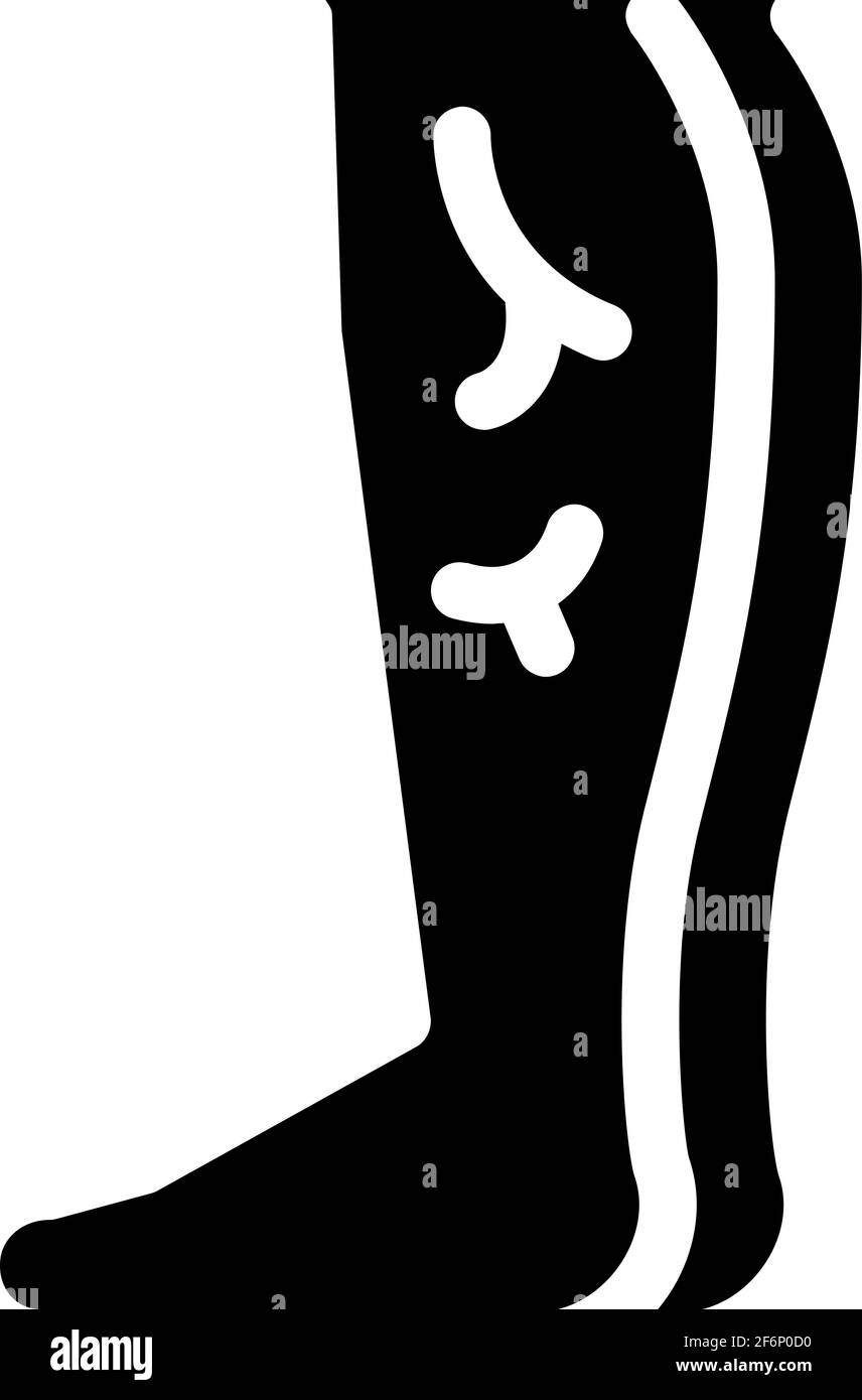 leg with varicose veins icon vector glyph illustration Stock Vector ...