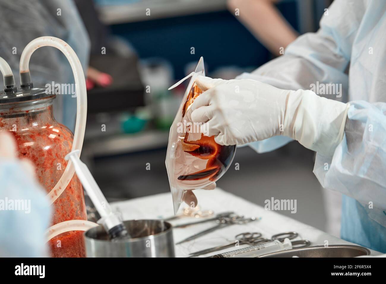 Plastic surgery to remove excess fat. Pumping fat into a jar during ...