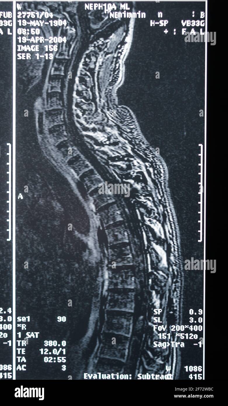 Magnetic resonance imaging, MRI, computed tomography, x-ray image. Cross section of the spine ...