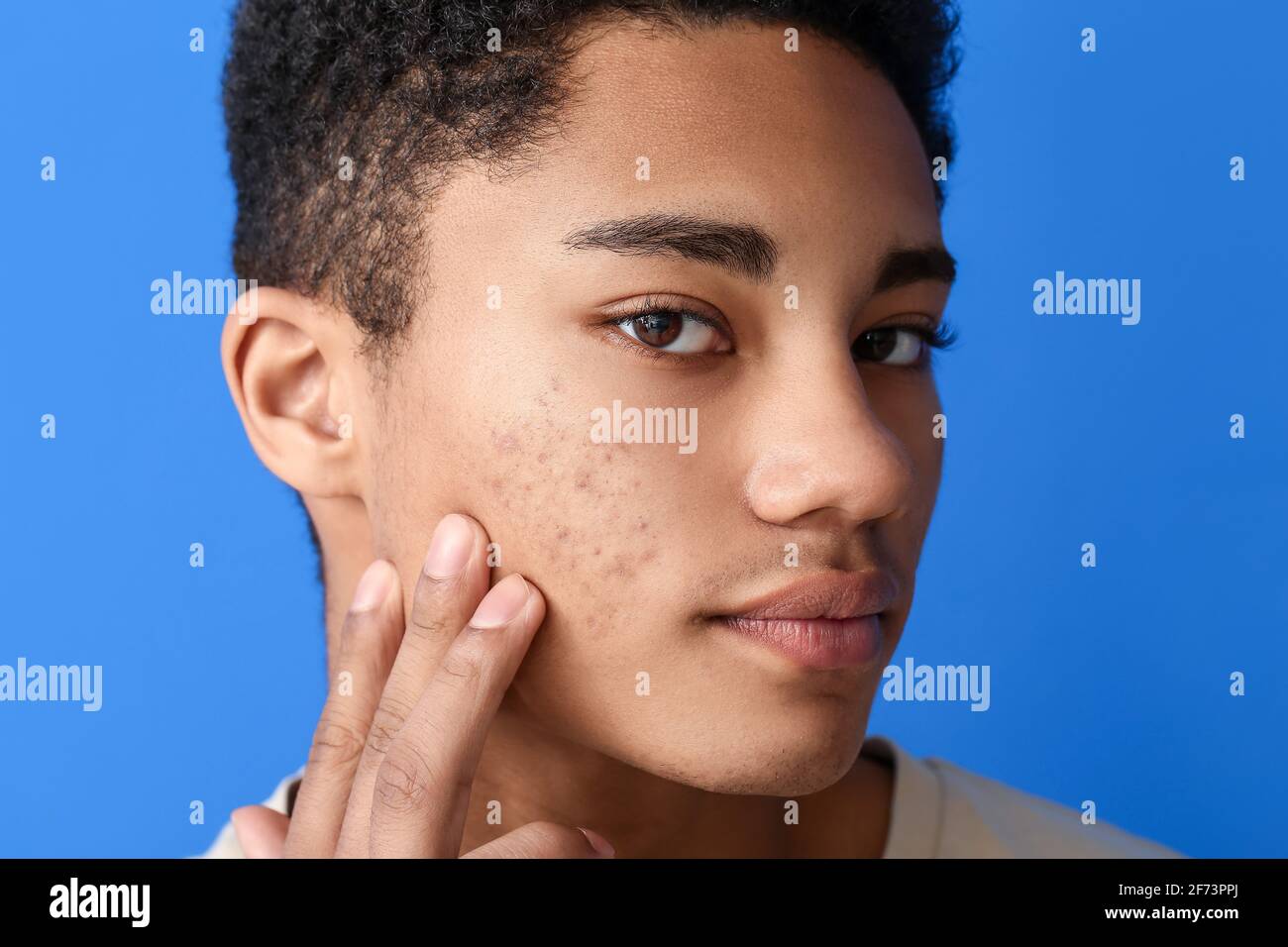 African-American teenage boy with acne problem on color background ...