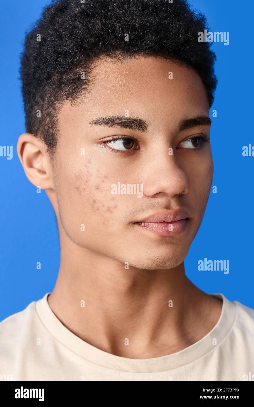 African-American teenage boy with acne problem on color background ...