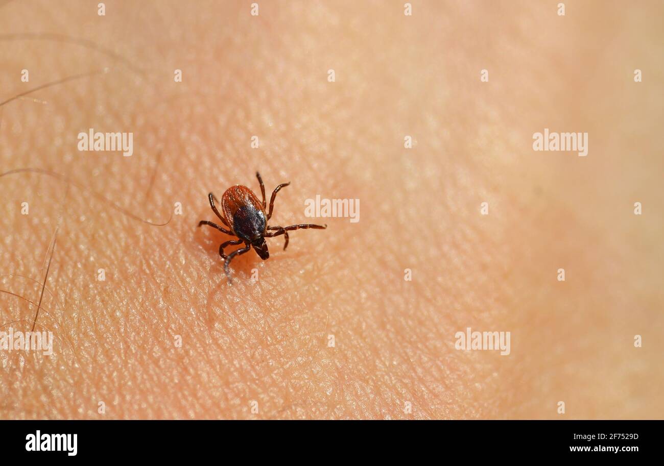 Tick ( Ixodes ricinus ) on human skin. Parasite transmit both Lyme ...