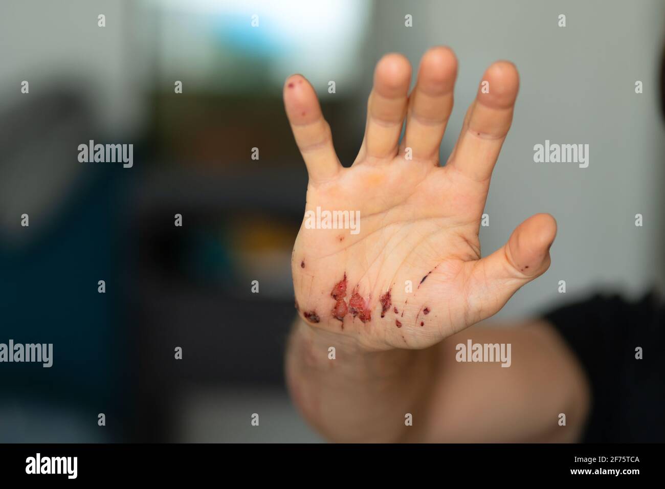 Bloody palm hi-res stock photography and images - Alamy