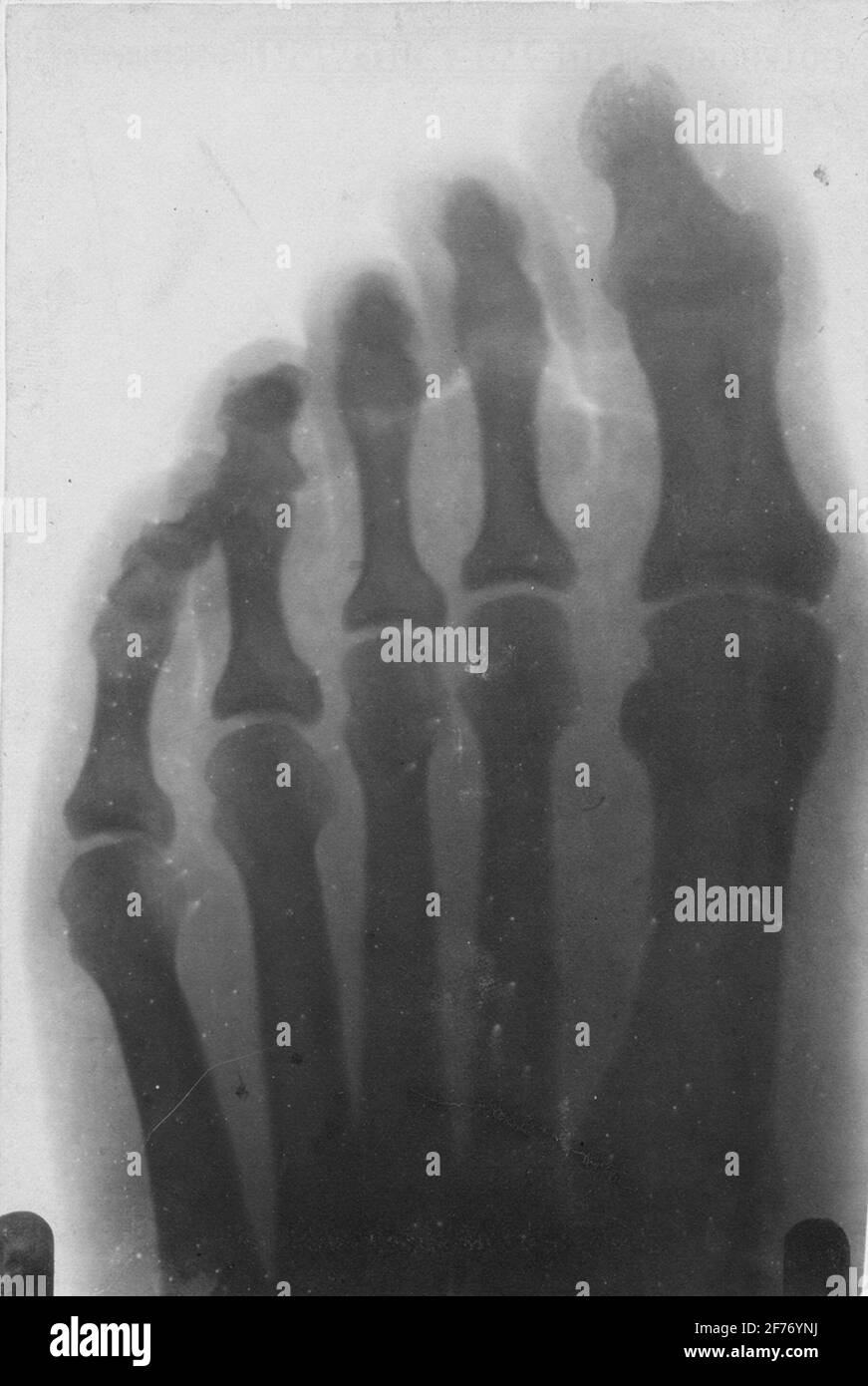 Right foot x ray hi-res stock photography and images - Alamy
