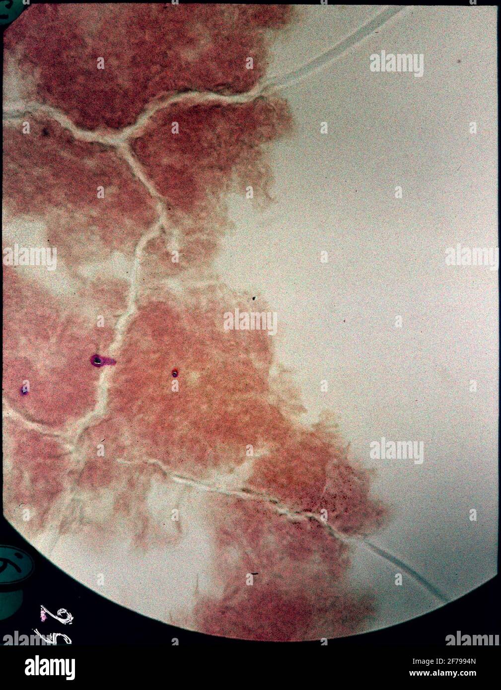Lumière autochrome. Medical photographs.A-blood cells undiluted B serum ...
