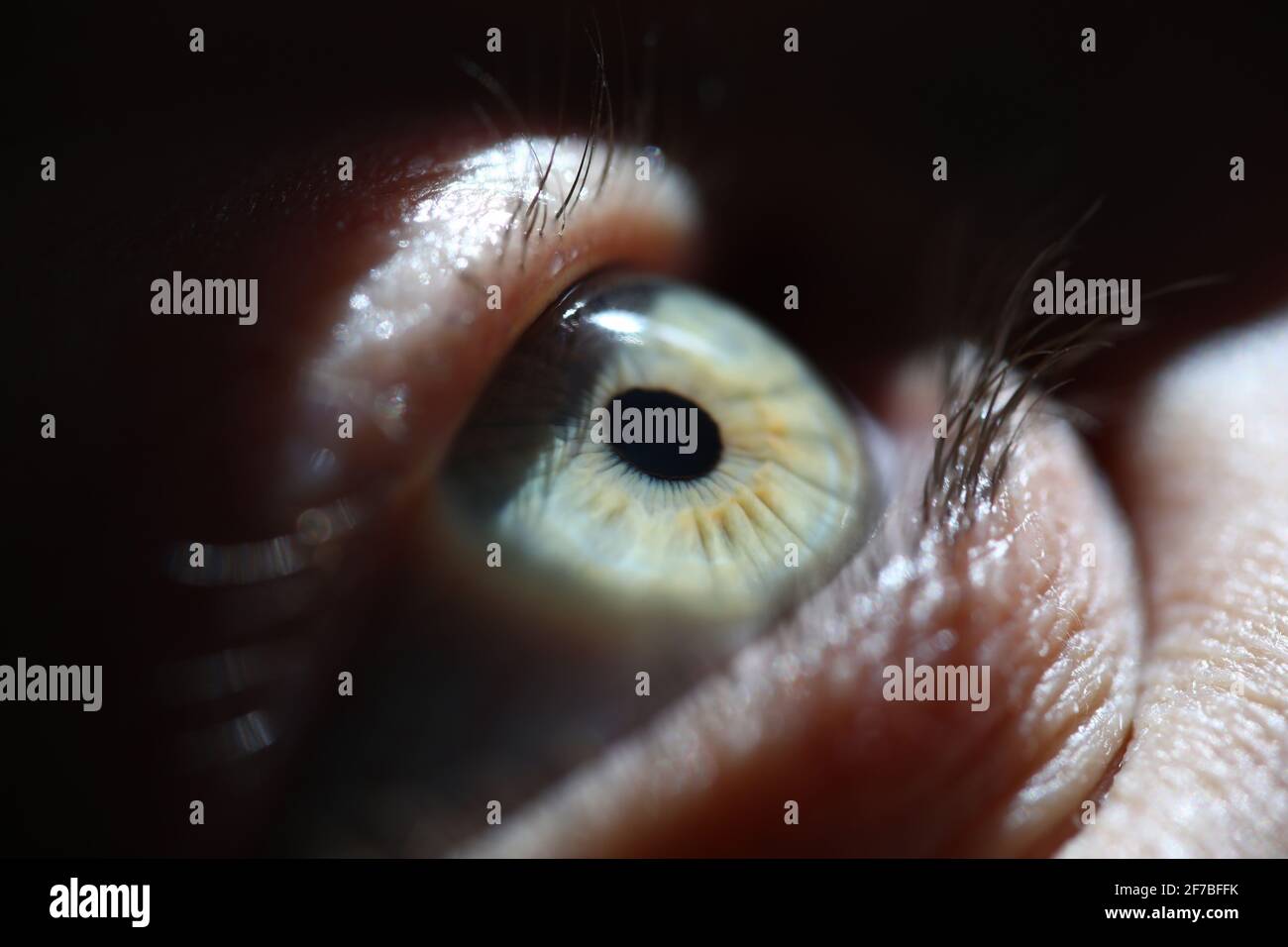 Retinal detachment surgery hi-res stock photography and images - Alamy