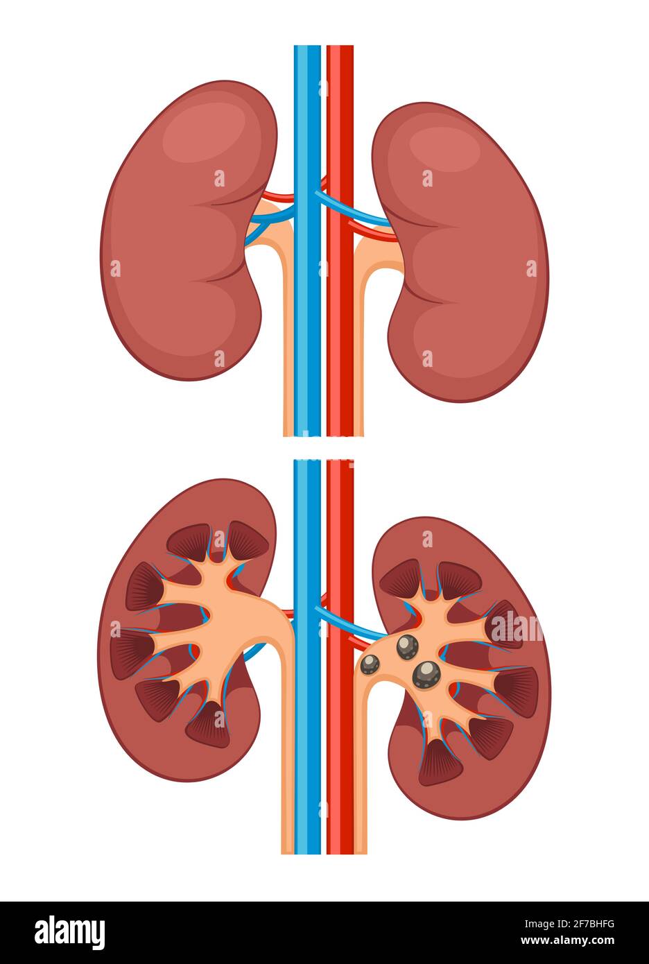 Kidney transplant infographic hi-res stock photography and images - Alamy