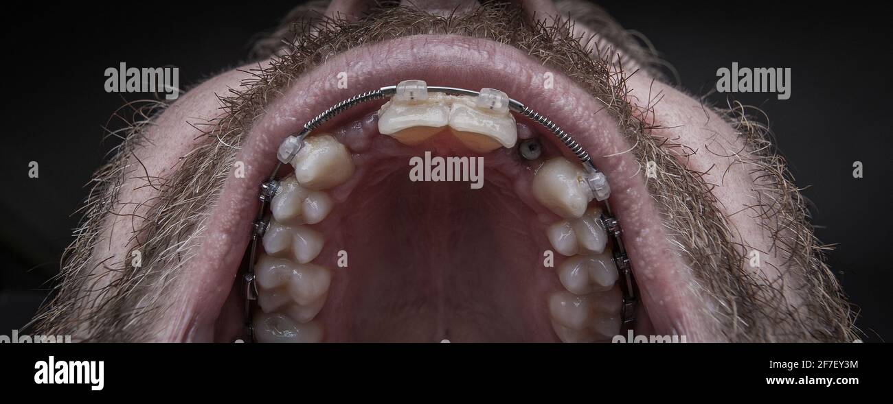 A macro shot of dental implant in the oral cavity and its Panoramic ...