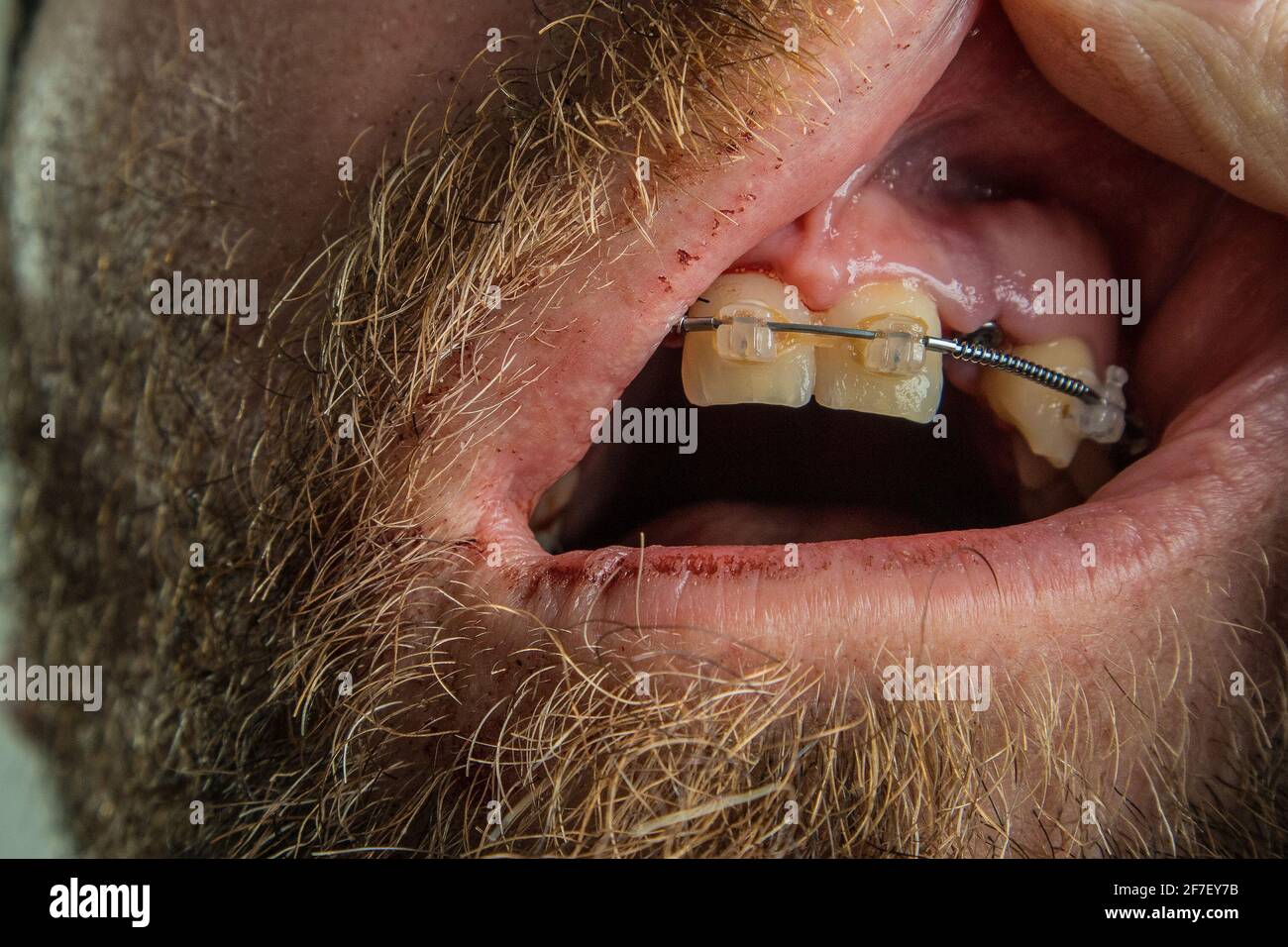 Visible tooth implant in a male gums, surrounded with mouth with dried ...