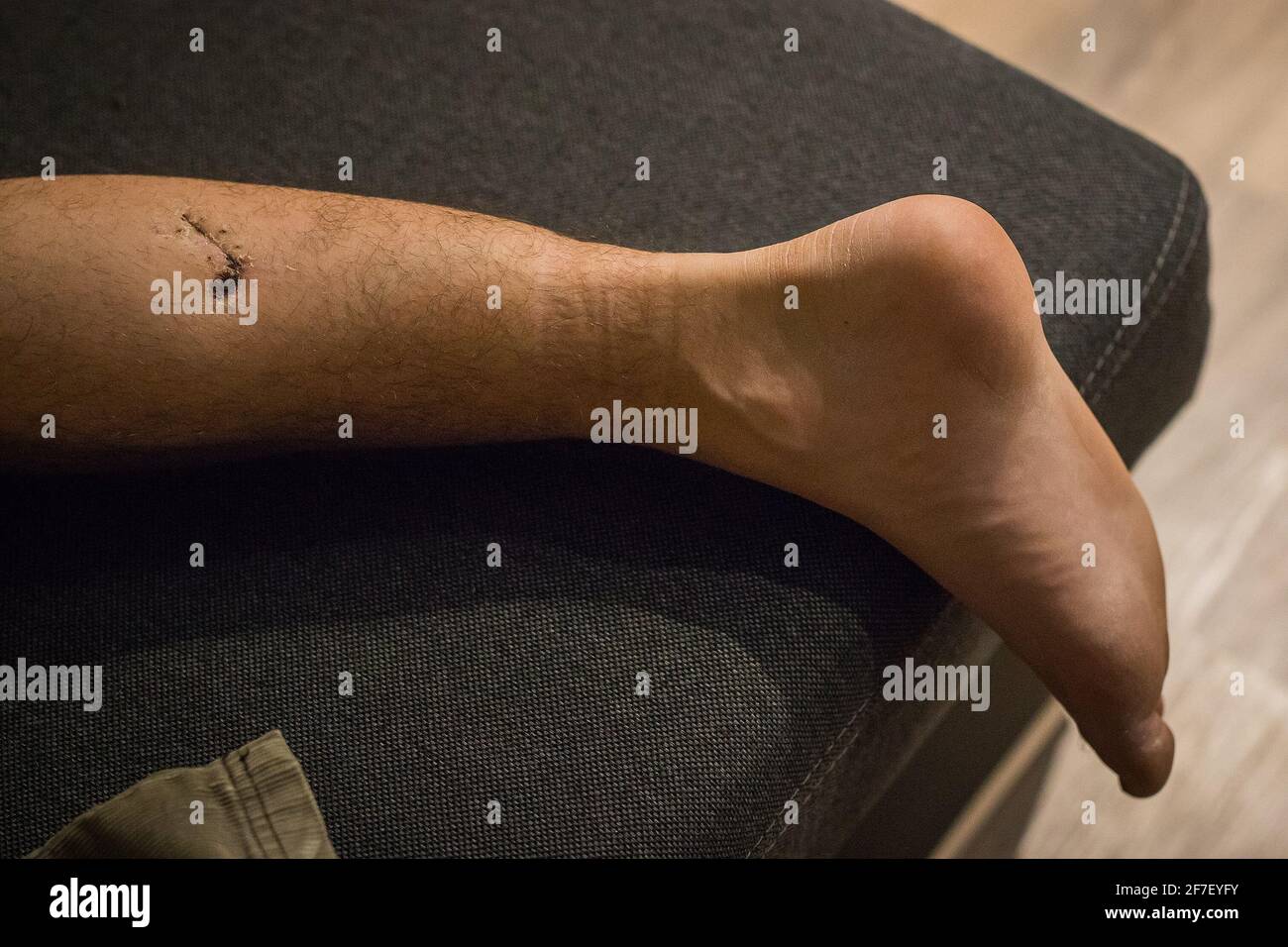 Overview of a healing wound and torn muscle on a leg. Visible scar ...