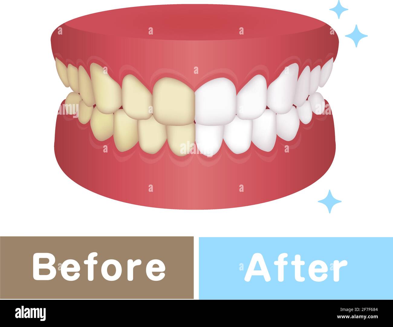 Teeth whitening vector illustration / before and after Stock Vector ...