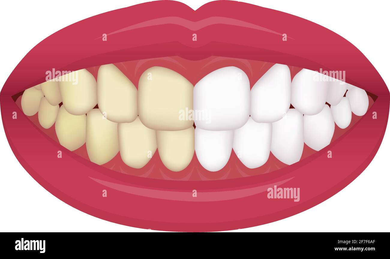 Teeth whitening vector illustration / before and after Stock Vector ...