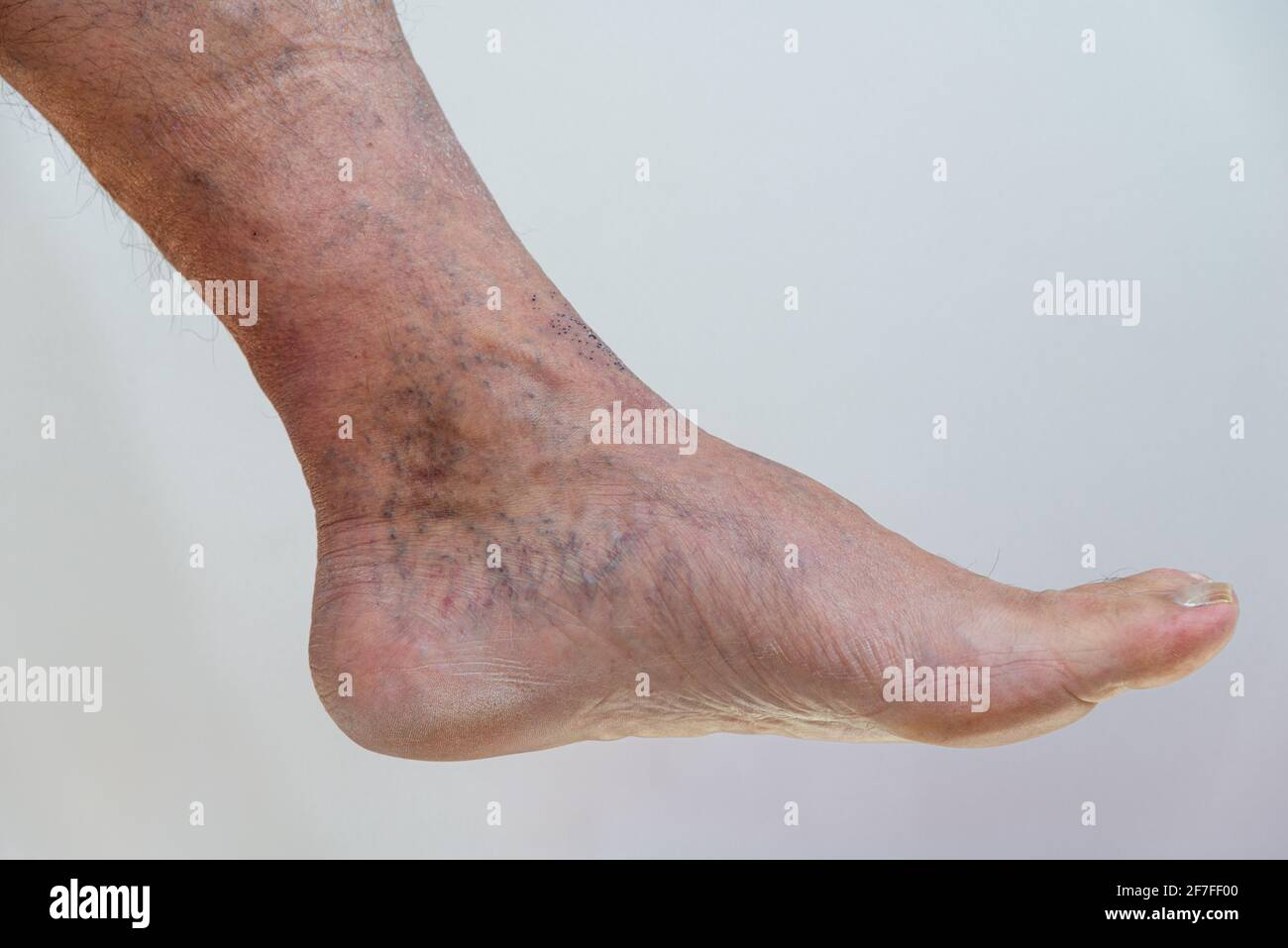 Varicose veins leg and foot hi-res stock photography and images - Alamy
