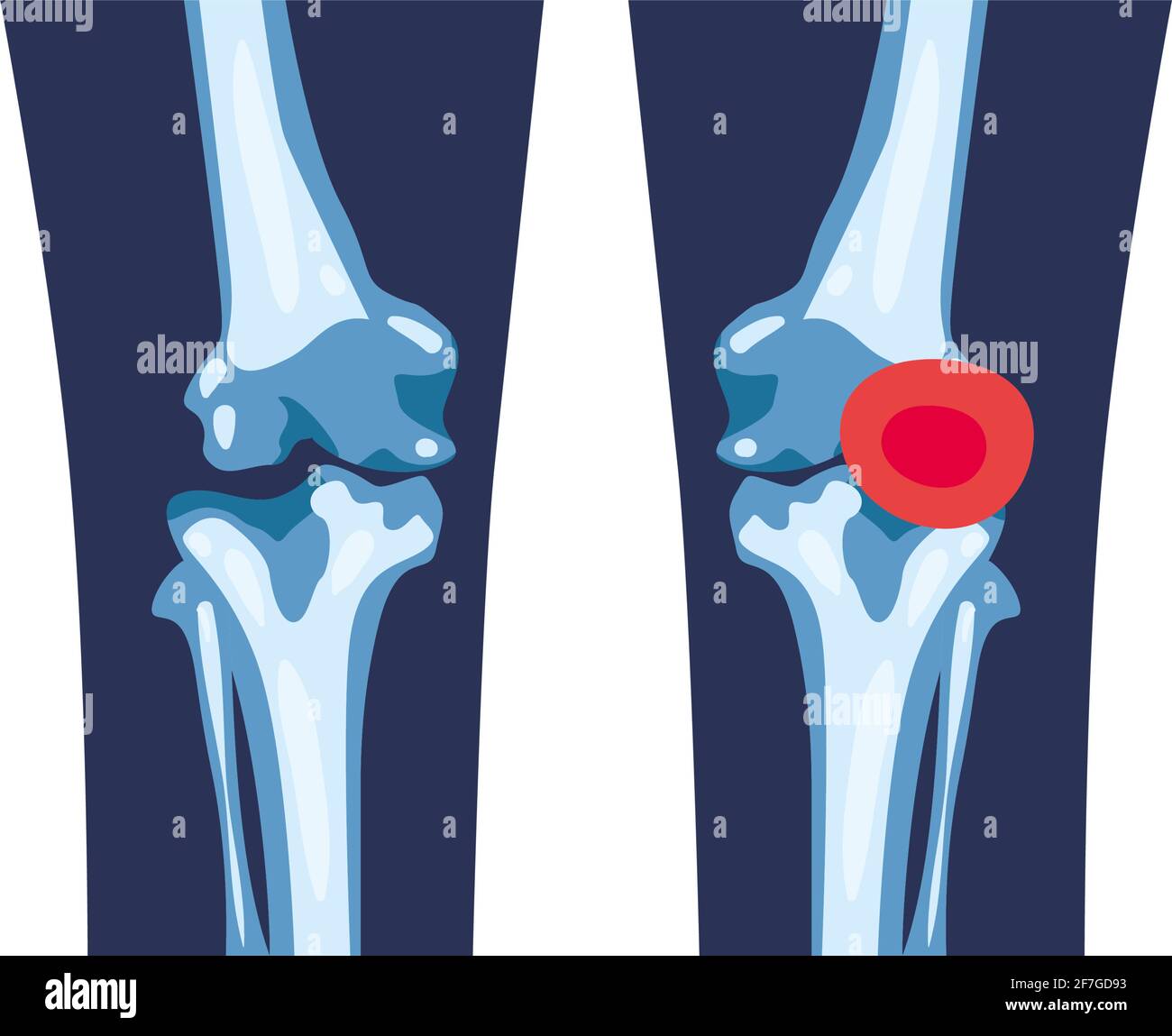 Isolated rheumatology blue legs bones Stock Vector Image & Art - Alamy