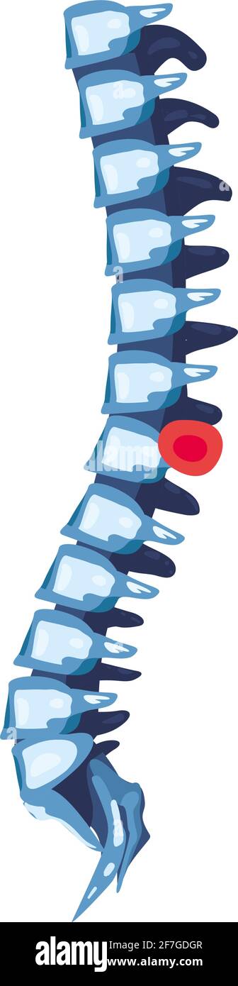 Isolated rheumatology blue spine bones Stock Vector Image & Art - Alamy