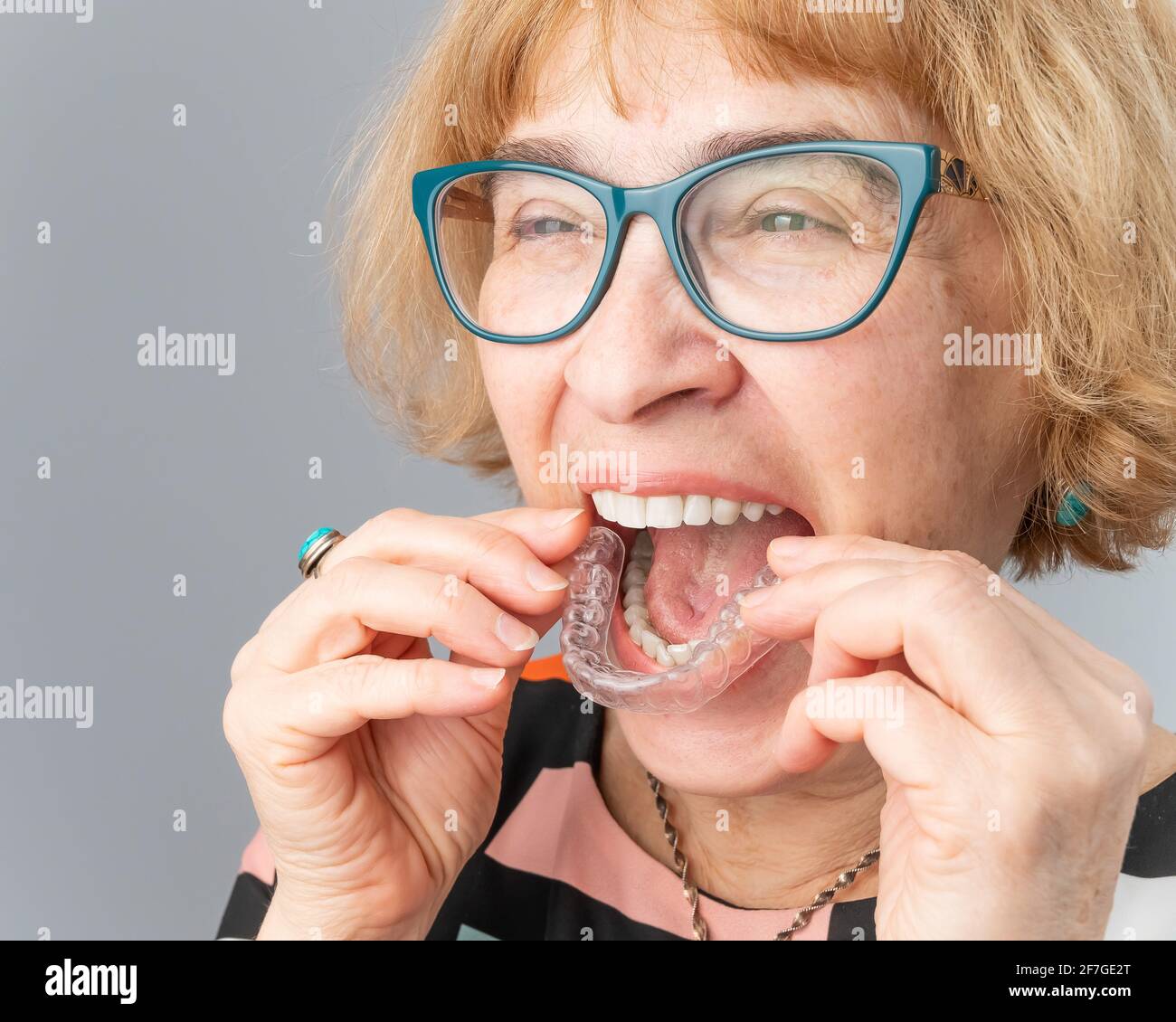 Removable braces hi-res stock photography and images - Alamy