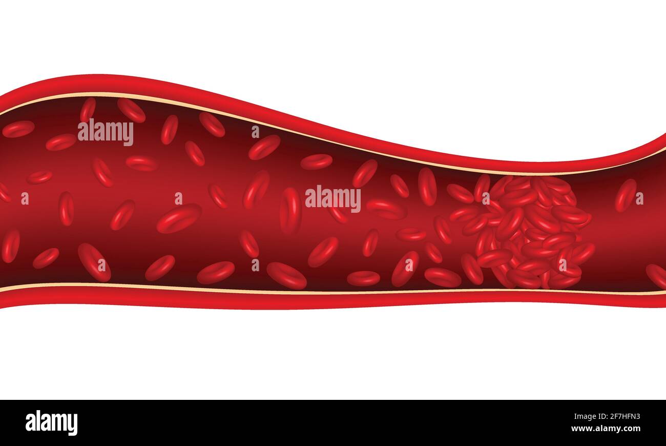 Deep vein thrombosis hi-res stock photography and images - Alamy