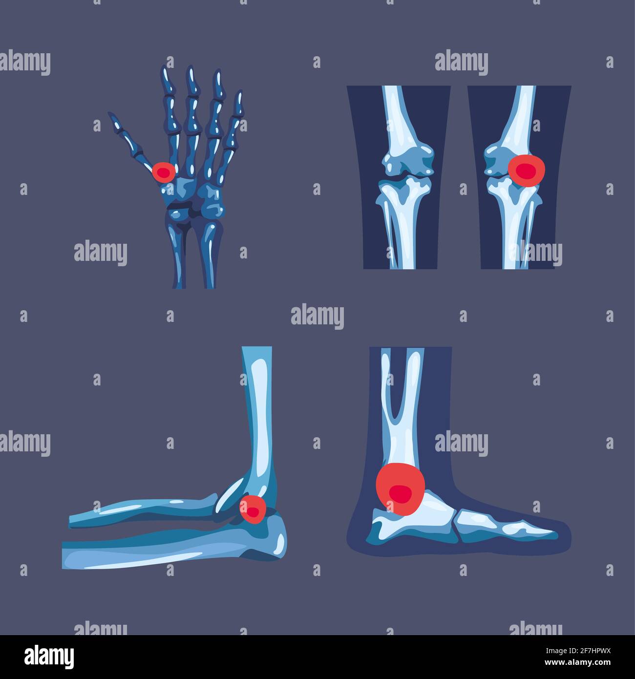 Rheumatology blue bones symbol set Stock Vector Image & Art - Alamy