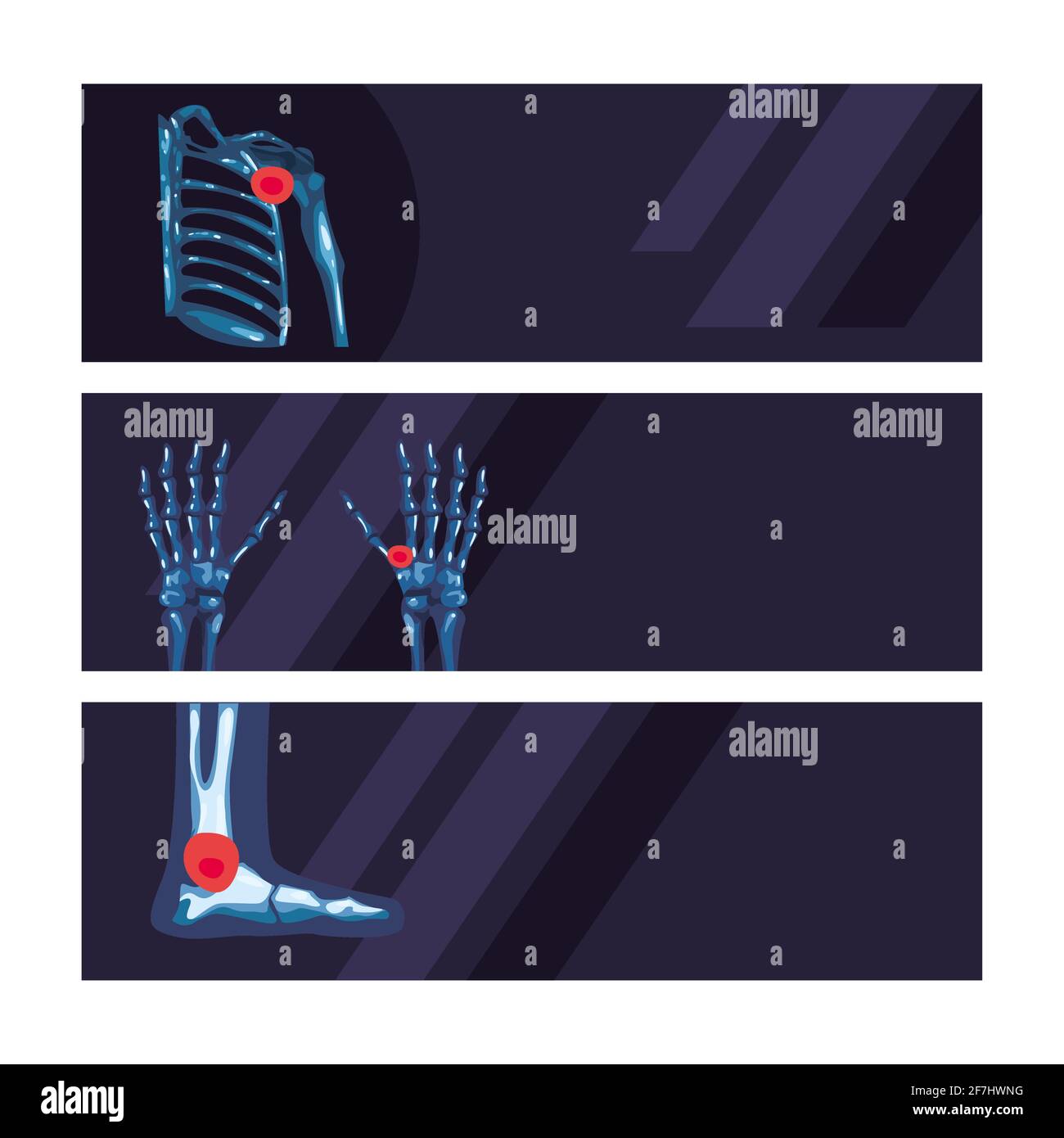 Rheumatology blue bones banners set Stock Vector Image & Art - Alamy