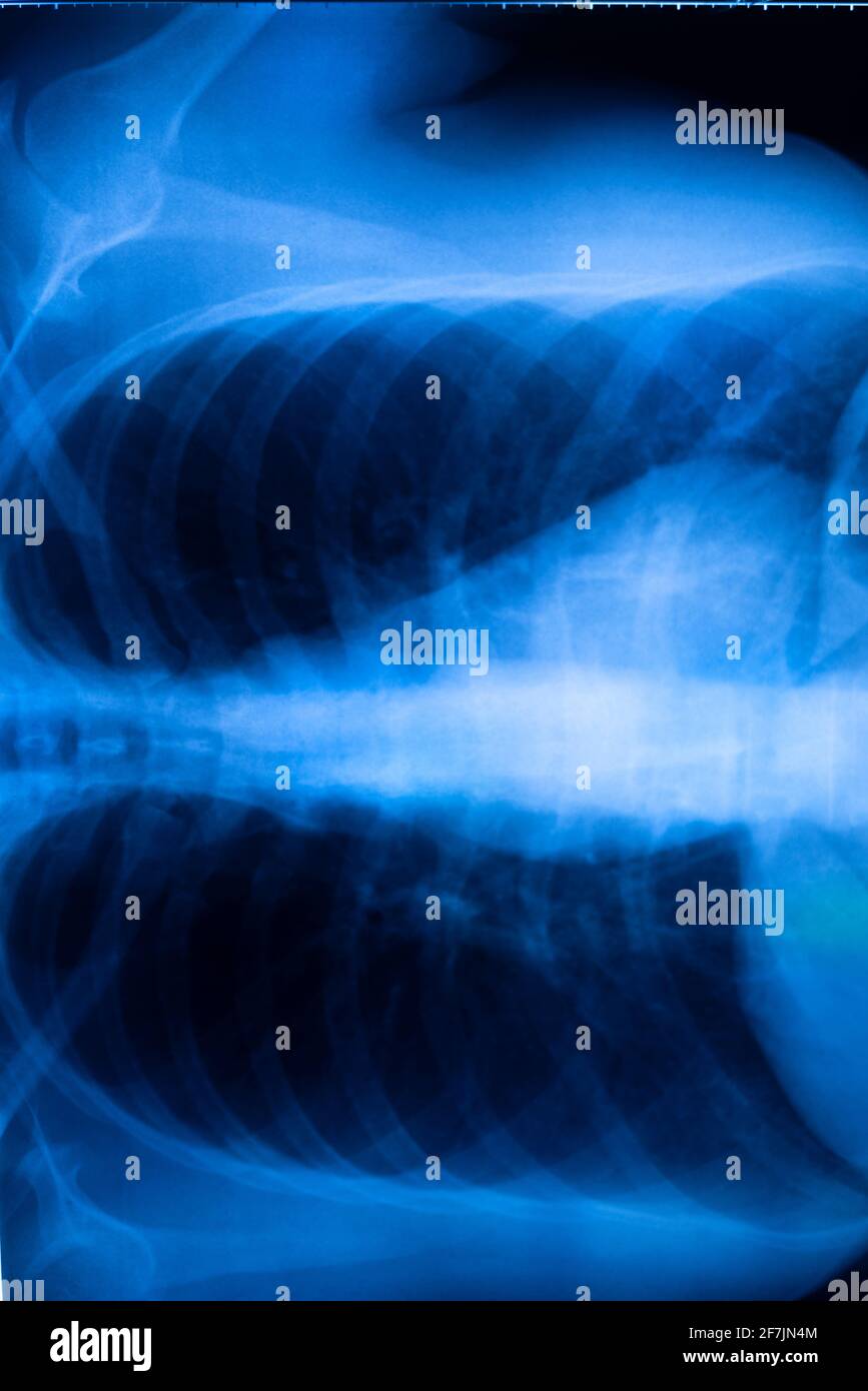 Lungs ribs x-ray scan test result Stock Photo - Alamy