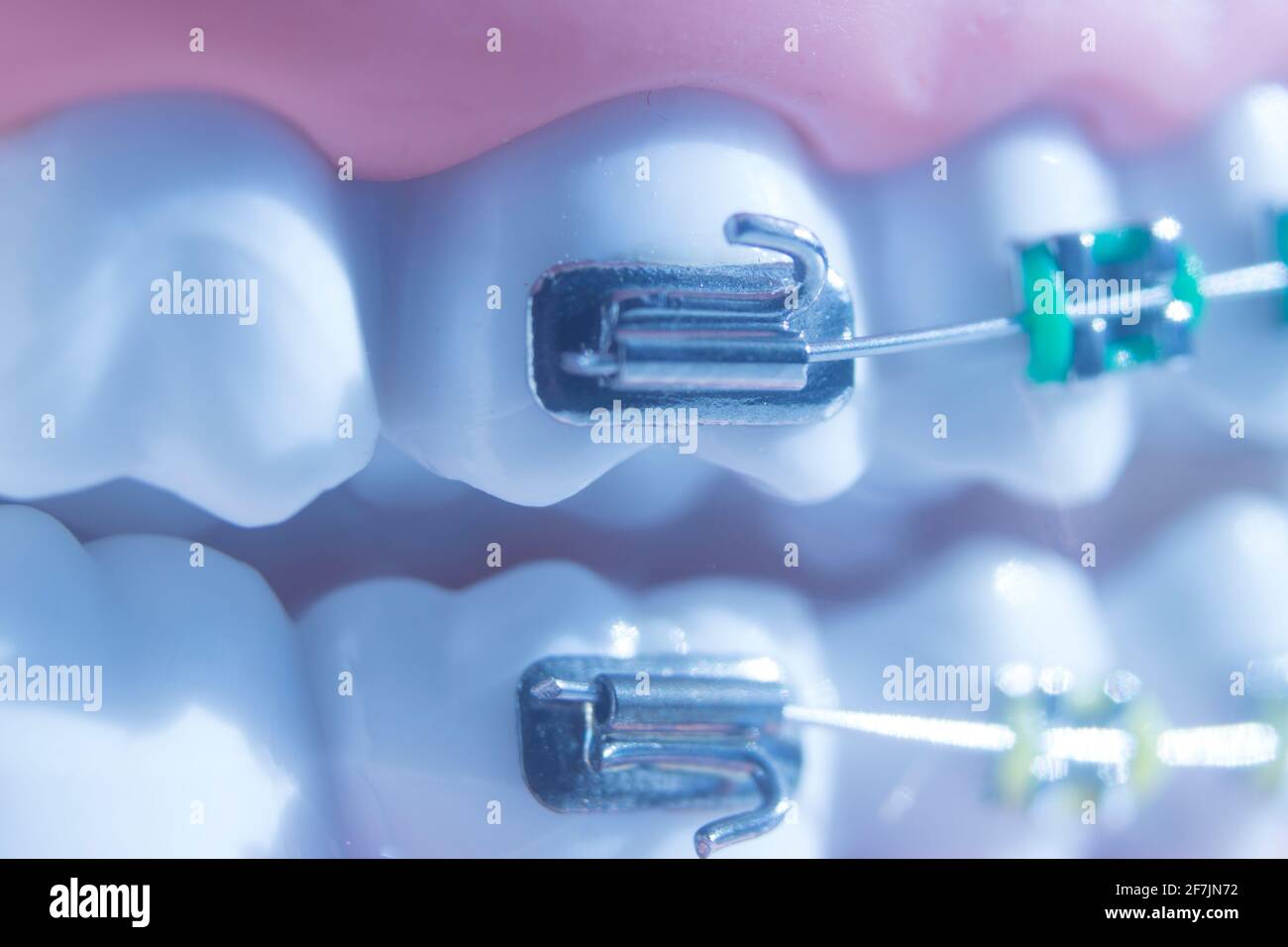 Modern metal brackets aligner straighterners used to correct alignment ...