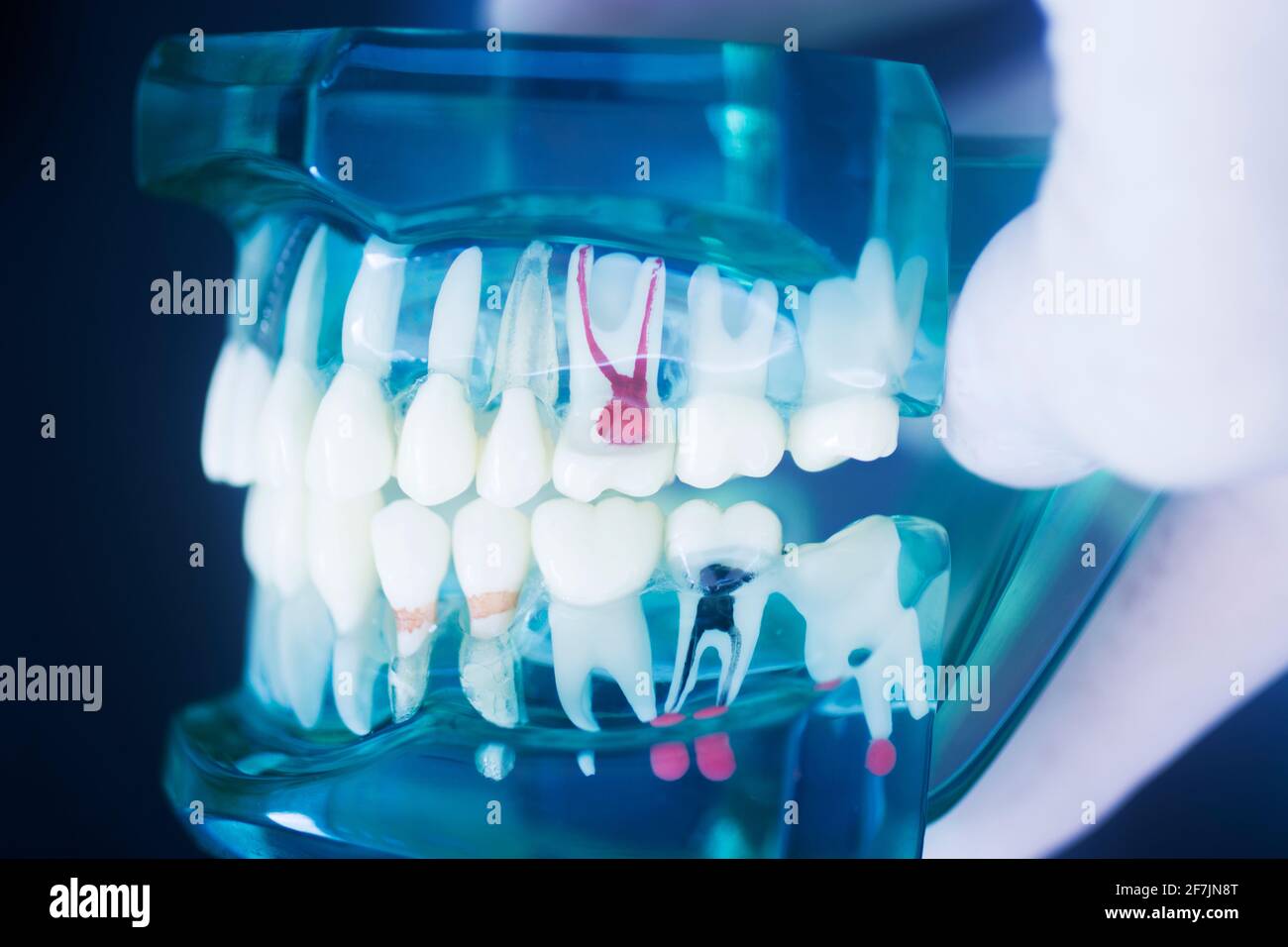 Teeth decay dentistry model showing caries in tooth Stock Photo - Alamy