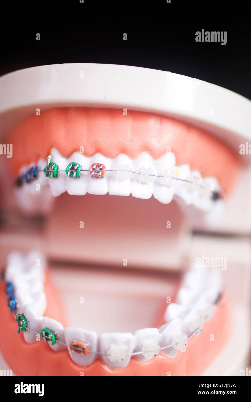 Dental teeth aligner bracket teaching student model showing gums and ...