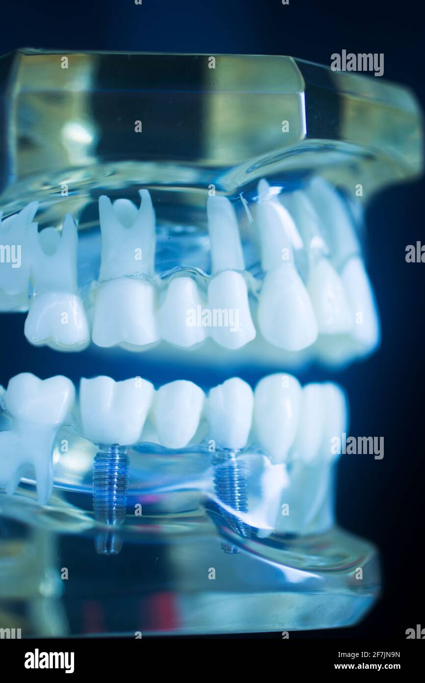 Dental tooth implant titanium prosthetic dentists model Stock Photo - Alamy