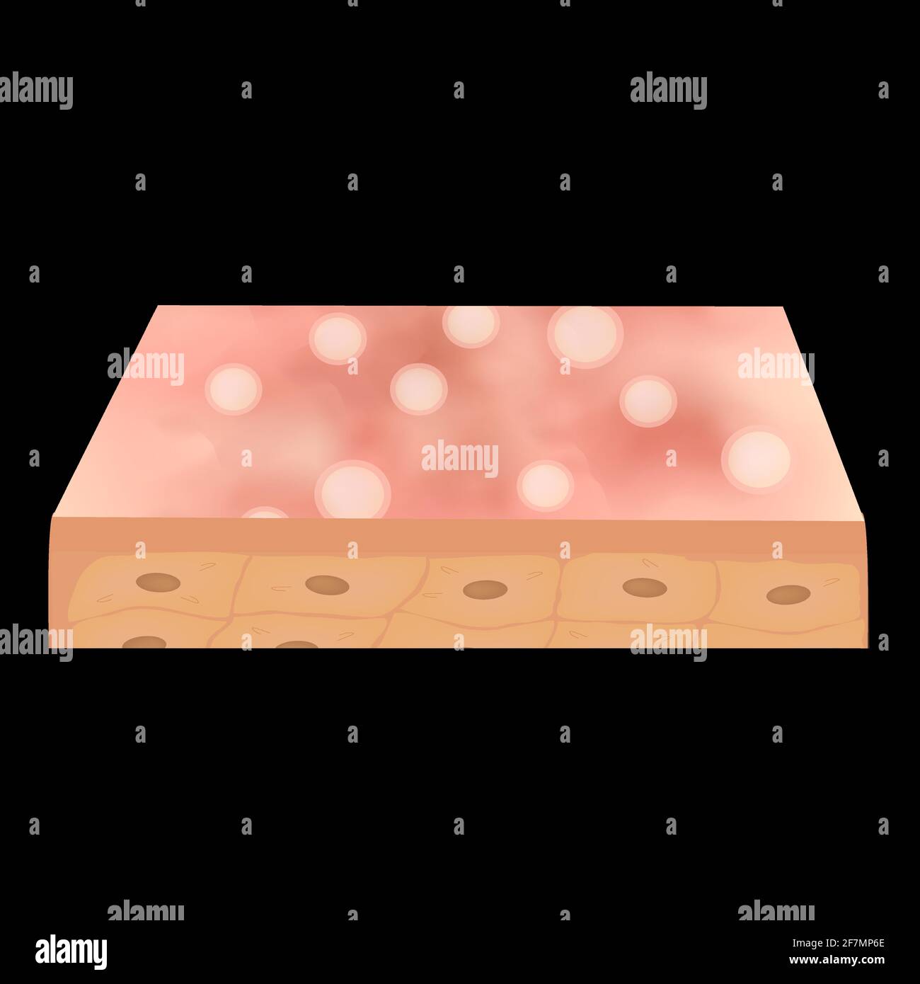 Comedones hi-res stock photography and images - Alamy