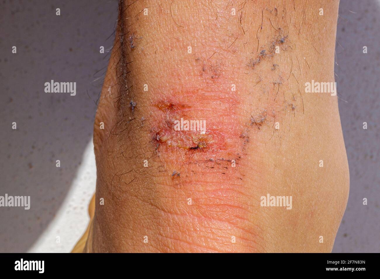 Detail of the wound produced by a burst blister on the achilles of an ...