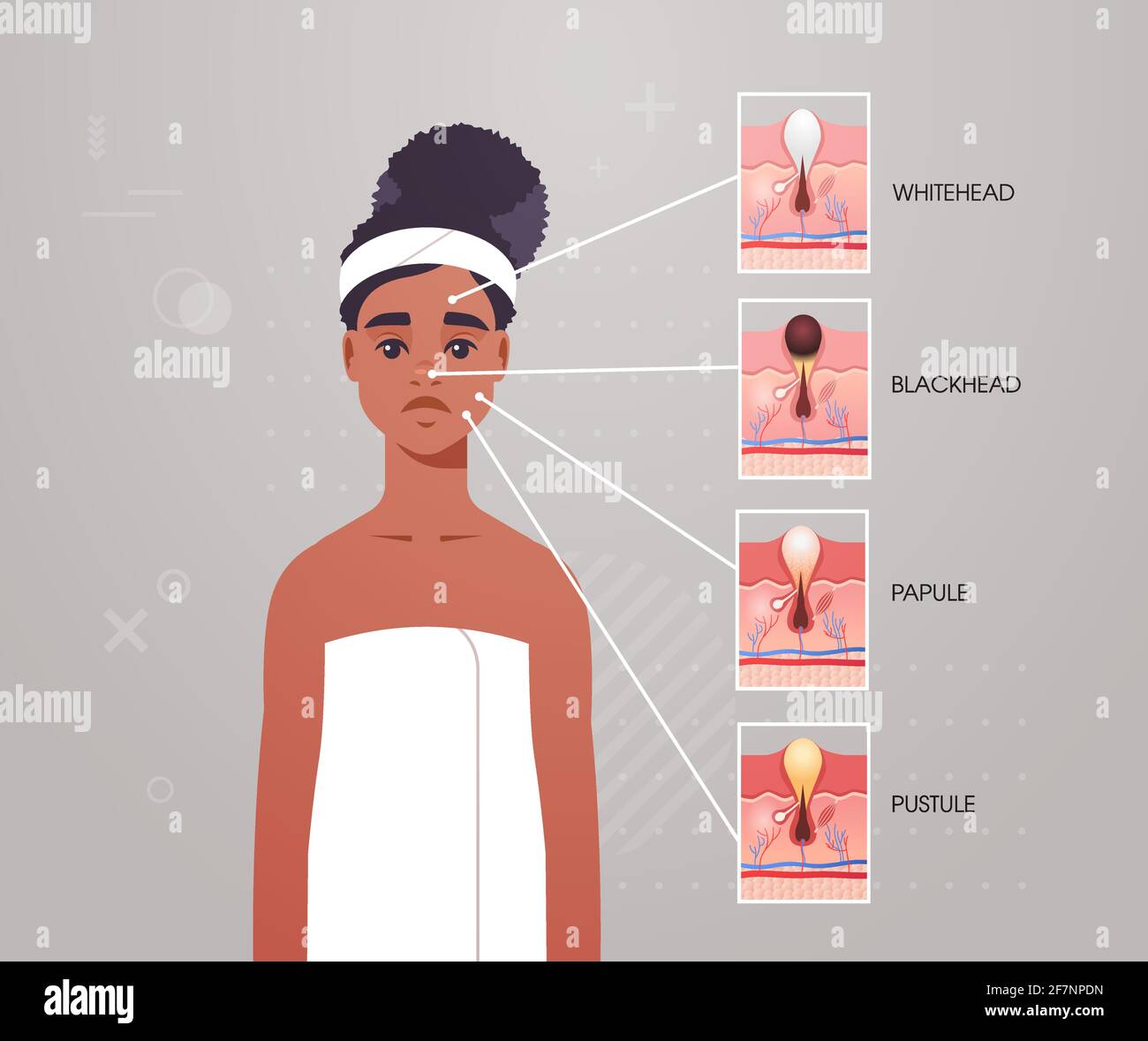 different types of facial skin acne pustule papule blackhead whitehead ...