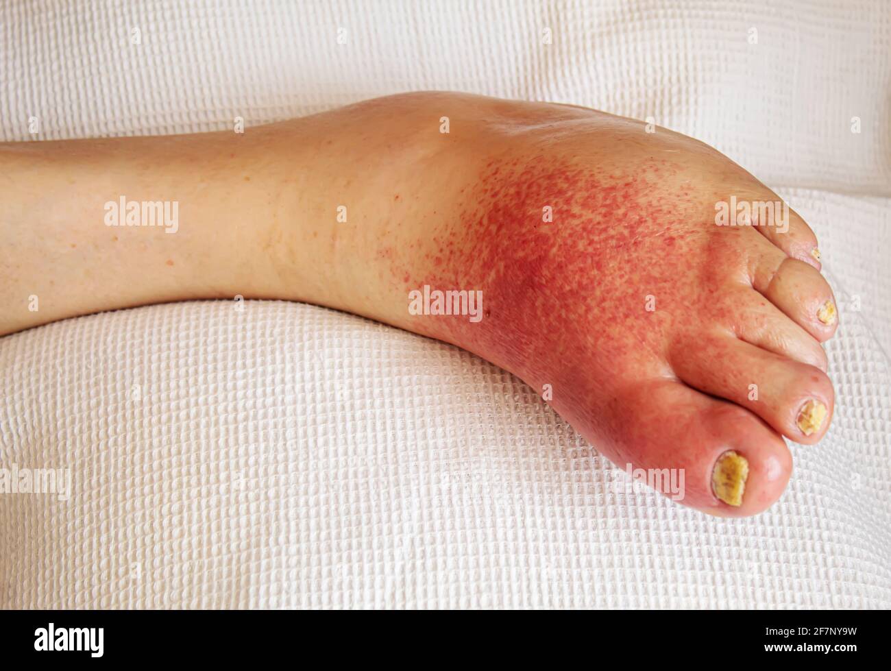 Sepsis skin hi-res stock photography and images - Alamy