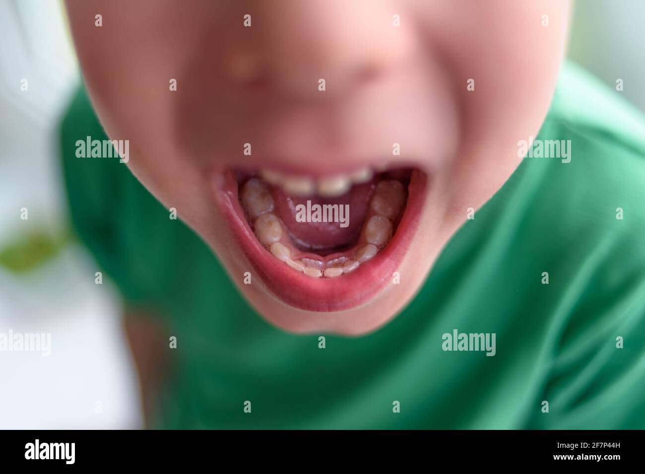 Boy with second row of teeth. Milk primary and permanent together Stock ...