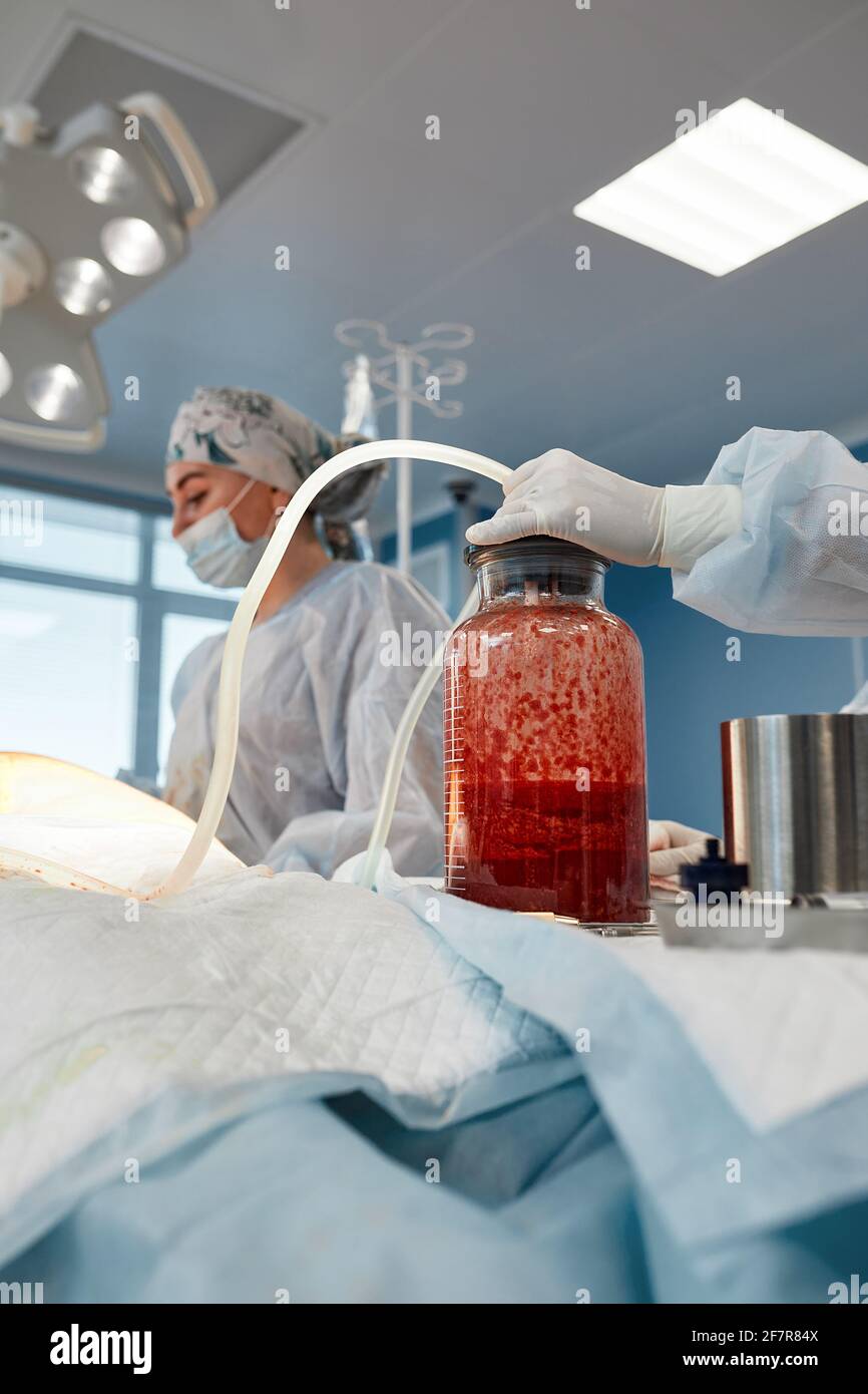 Plastic surgery to remove excess fat. Pumping fat into a jar during ...