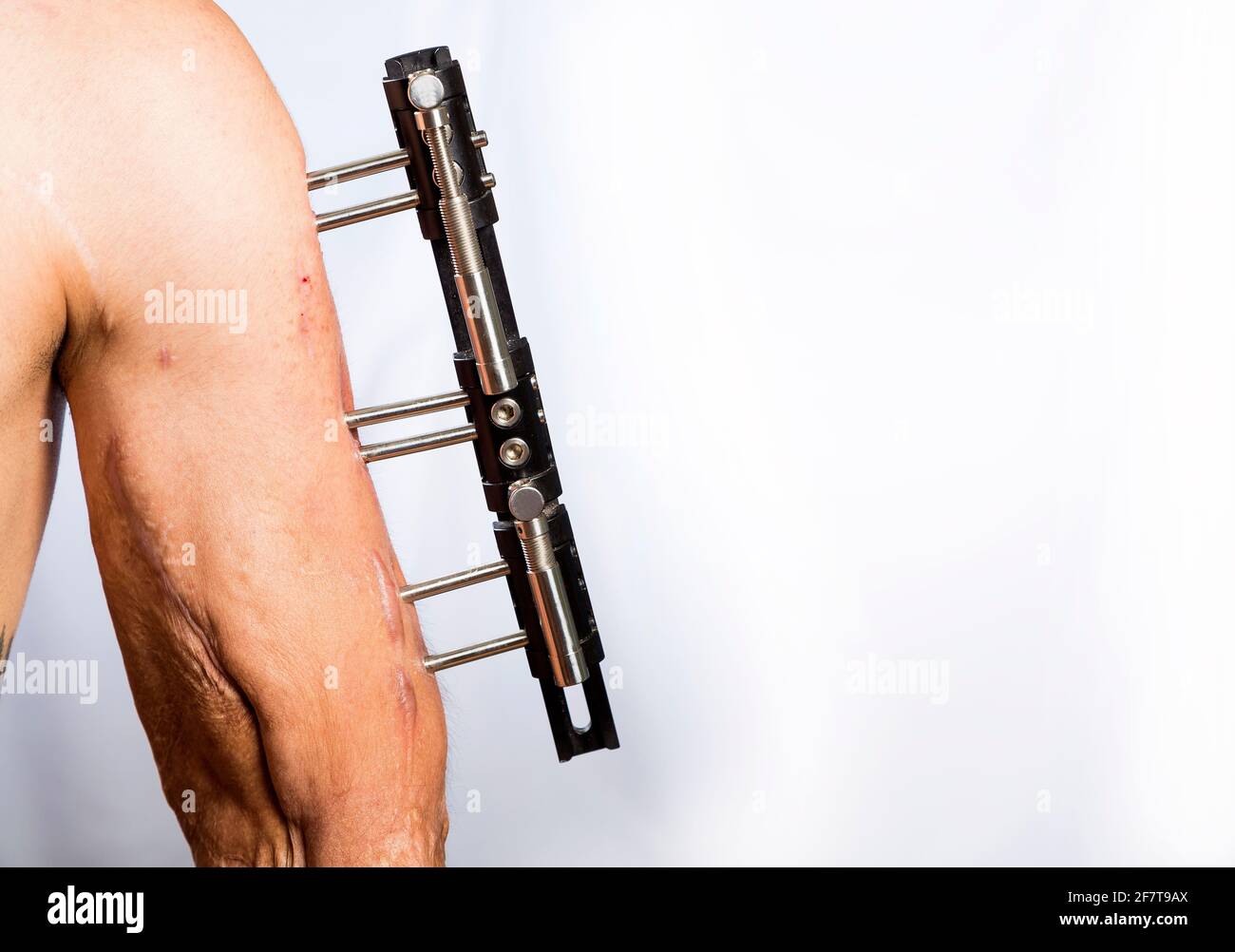 Broken arm with external metal fixator - White background Stock Photo ...