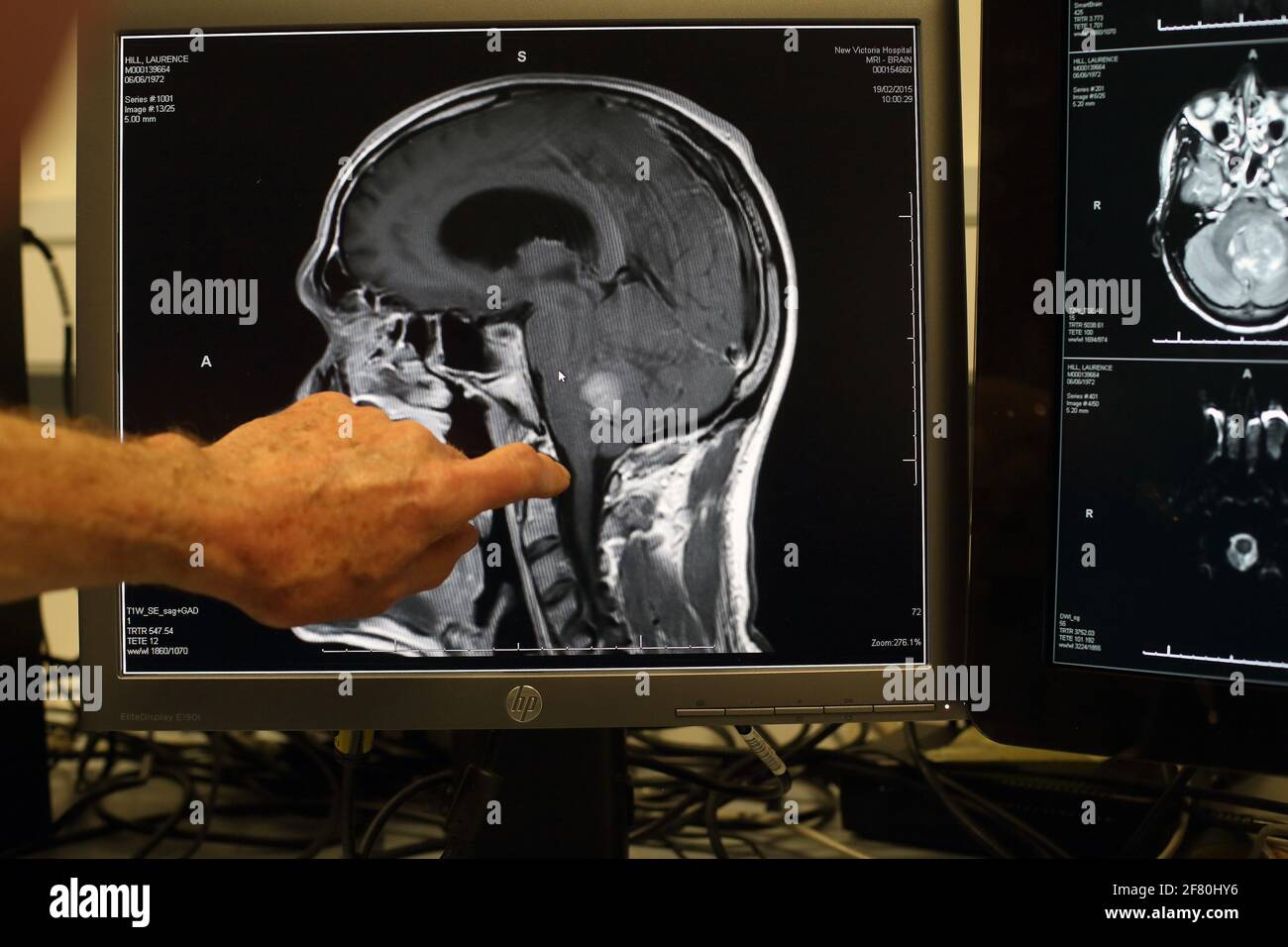 Doctor pointing at MRI of human brain at computer screen Stock Photo ...