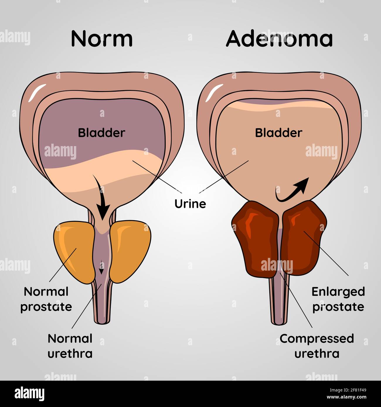 Male Bladder Pain