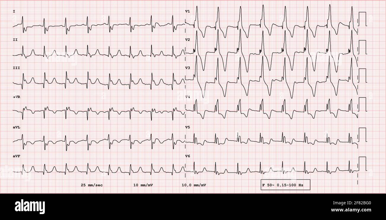 ECG example of a pathological 12-lead rhythm, Fallot's tetralogy Stock ...
