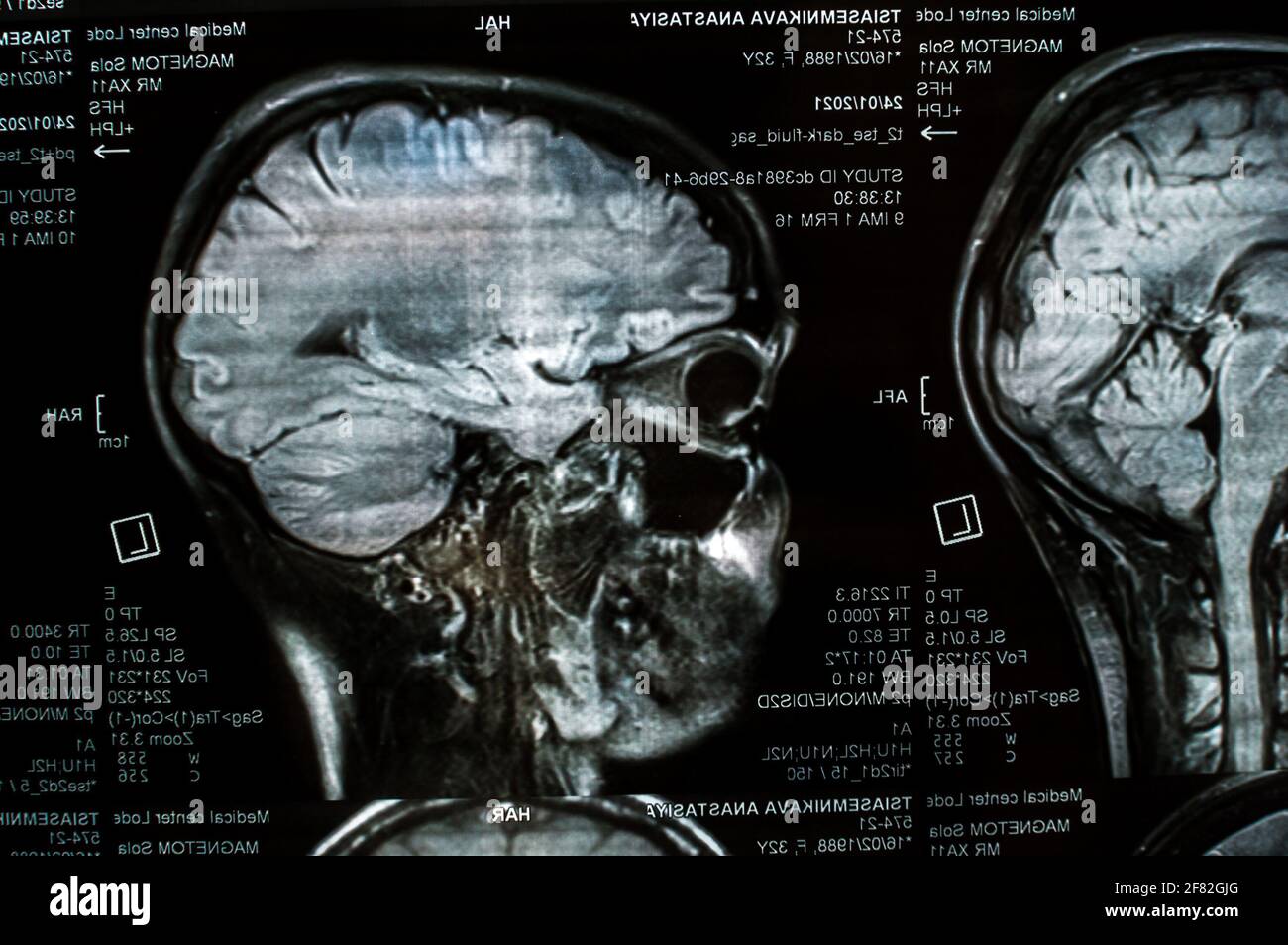 Magnetic resonance imaging of the brain close up. MRI Stock Photo - Alamy