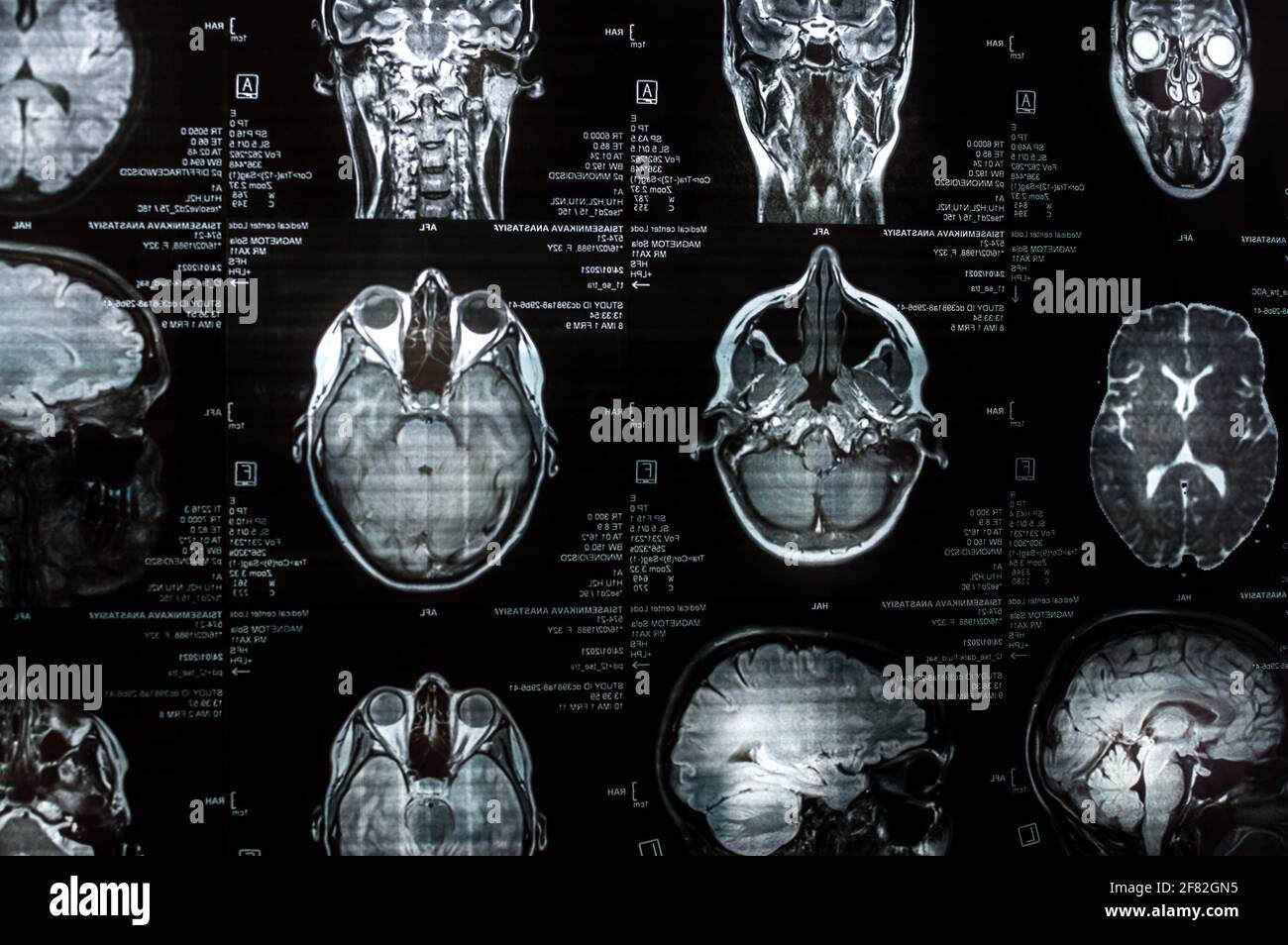 Close up of the mri scan of the human brain hi-res stock photography and images - Alamy
